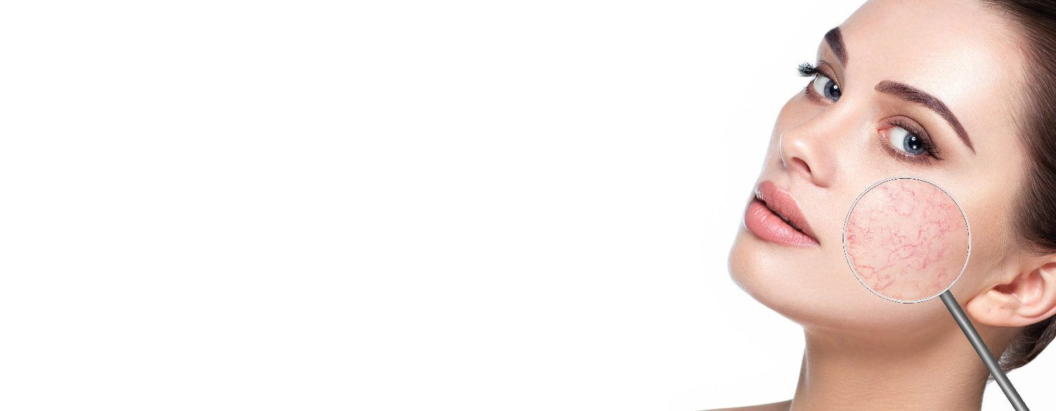 Laser Spider Veins Removal | Crystal Care Clinic
